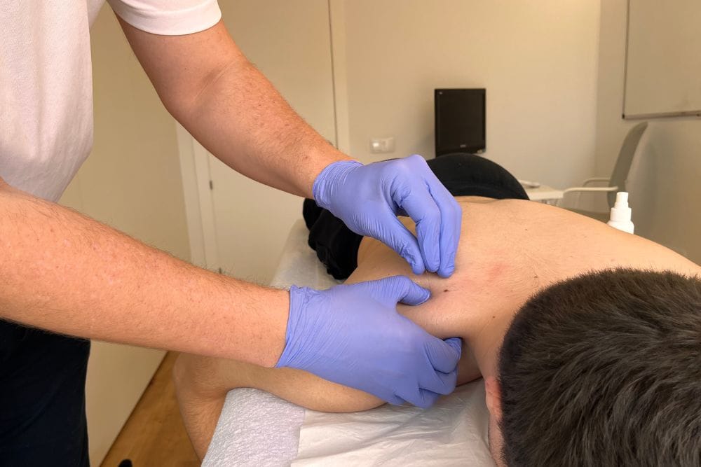 Punción seca para el dolor cervical (cervicalgia) - Egea Fisioterapia